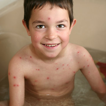 「Varicelle」の写真素材 | 89件の無料イラスト画像 | Adobe Stock