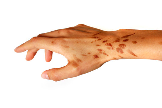 Wundbrand-Bilder: Stock-Fotos & -Videos. | Adobe Stock