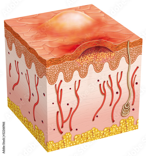 "pustula" Fotos de archivo e imágenes libres de derechos en Fotolia.com ...
