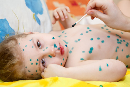 「Waterpox」の画像 - 111 件の Stock 写真、ベクターおよびビデオ | Adobe Stock