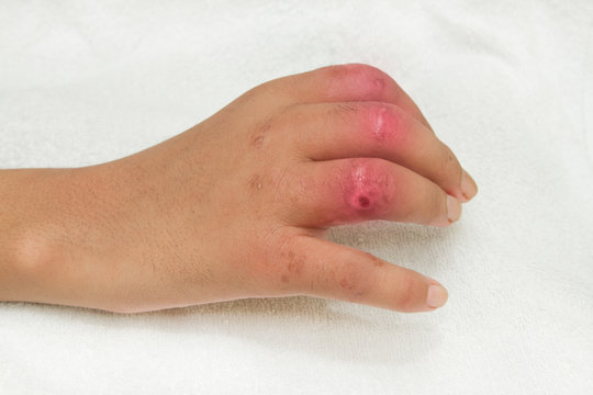 Smashed Hand Injury