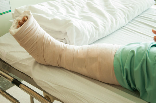 "Broken Leg" Images – Browse 3,588 Stock Photos, Vectors, and Video ...