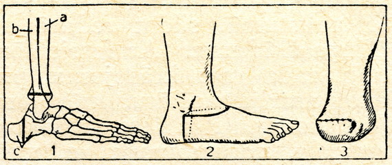 Search photos "pirogoff amputation"