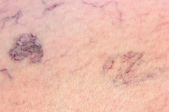 รูปภาพPhlebitis – เลือกดูภาพถ่ายสต็อก เวกเตอร์ และวิดีโอ1,576 | Adobe Stock