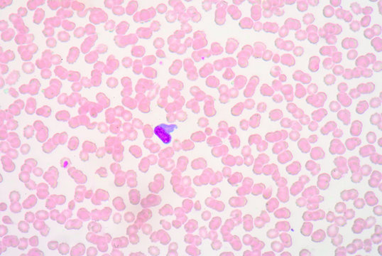 รูปภาพMetamyelocyte – เลือกดูภาพถ่ายสต็อก เวกเตอร์ และวิดีโอ142 | Adobe ...