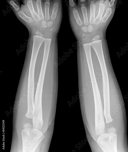 "film x-ray forearm : show normal infant's bone" Stock photo and ...