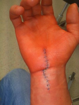 รูปภาพHandverletzung – เลือกดูภาพถ่ายสต็อก เวกเตอร์ และวิดีโอ134 ...