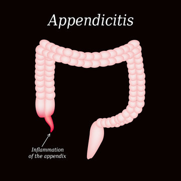 รูปภาพDiverticulitis – เลือกดูภาพถ่ายสต็อก เวกเตอร์ และวิดีโอ1,780 ...