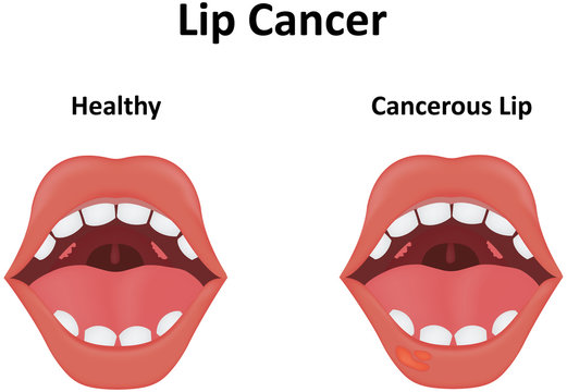 Early Lip Cancer