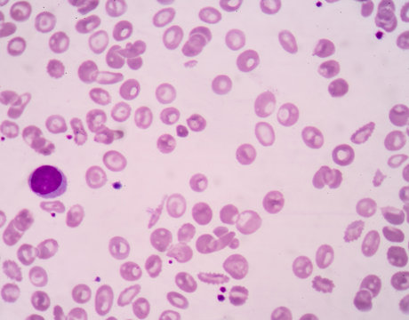 รูปภาพMetamyelocyte – เลือกดูภาพถ่ายสต็อก เวกเตอร์ และวิดีโอ142 | Adobe ...