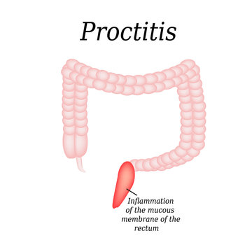 รูปภาพProctosigmoiditis – เลือกดูภาพถ่ายสต็อก เวกเตอร์ และวิดีโอ19 ...