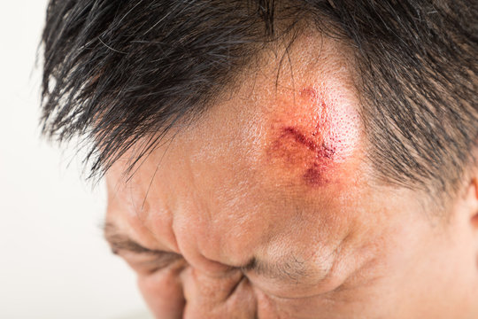 Skin Abrasion On Face