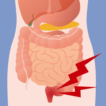 รูปภาพEnteritis – เลือกดูภาพถ่ายสต็อก เวกเตอร์ และวิดีโอ954 | Adobe Stock