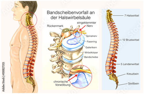"Bandscheibenvorfall am Hals" Stockfotos und lizenzfreie Bilder auf ...