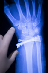"hand Injury" photos, royalty-free images, graphics, vectors & videos ...