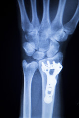 "hand Injury" photos, royalty-free images, graphics, vectors & videos ...