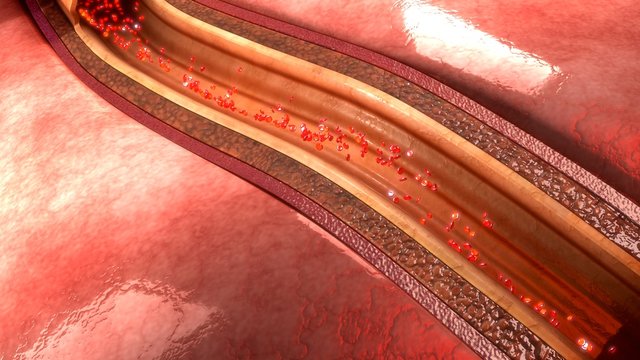 รูปภาพCoronary – เลือกดูภาพถ่ายสต็อก เวกเตอร์ และวิดีโอ42,880 | Adobe Stock