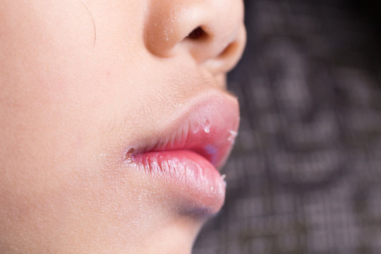 Cheilosis Images – Browse 14,802 Stock Photos, Vectors, and Video ...