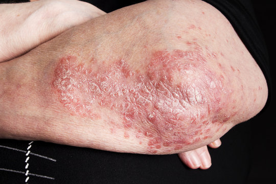 Erythroderma Images – Browse 63 Stock Photos, Vectors, and Video ...