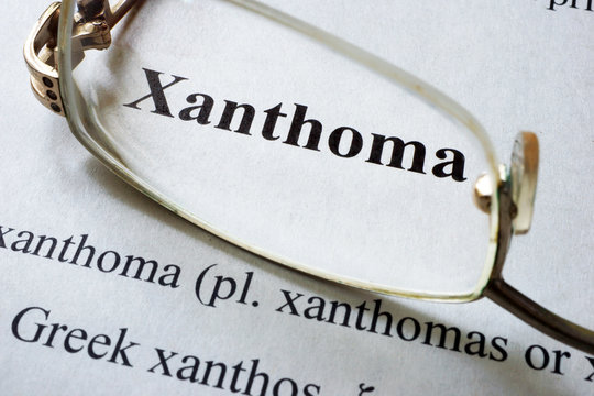 Xanthoma Images – Browse 42 Stock Photos, Vectors, and Video | Adobe Stock