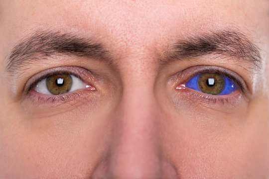 Bindehautsack Bilder – Durchsuchen 1,195 Archivfotos, Vektorgrafiken ...