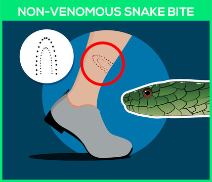 Non Poisonous Snake Bite Wounds