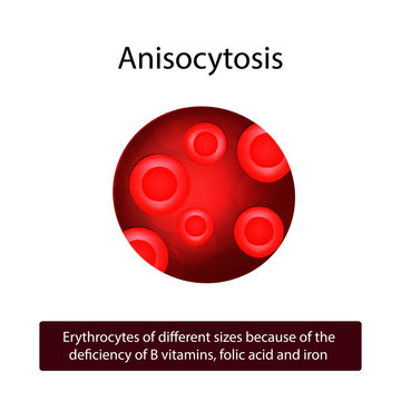 Anisocytosis Rbc