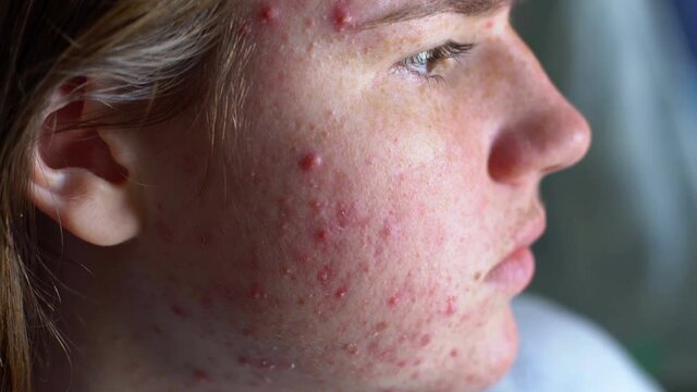 Acne Images – Browse 241,241 Stock Photos, Vectors, and Video | Adobe Stock