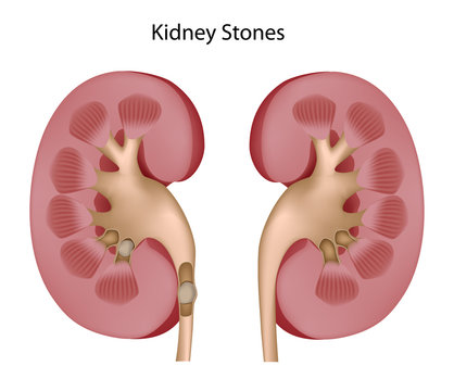 Human Kidney Stone