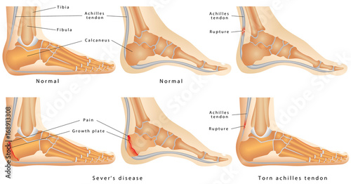 "Ankle, Calcaneal Apophysitis, Achilles tendon" Stock image and royalty ...