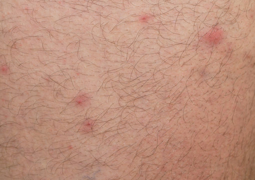 Flohbiss Bilder – Durchsuchen 2,819 Archivfotos, Vektorgrafiken und ...