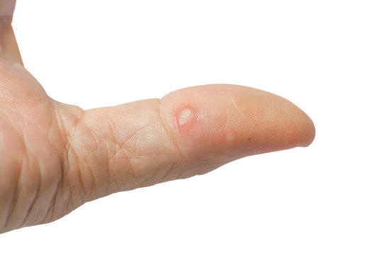 Vesicles On Fingers