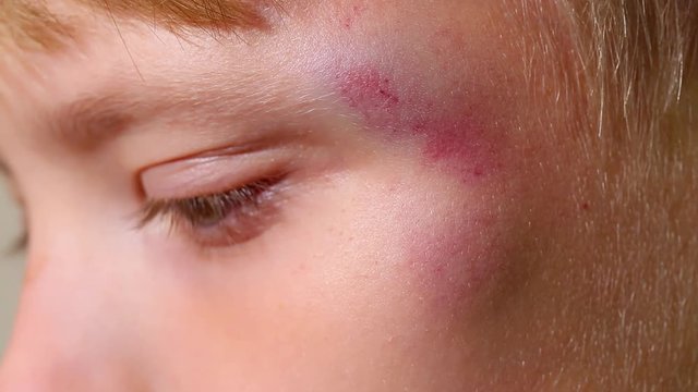 Blue(Bruise) Images – Browse 6,811 Stock Photos, Vectors, and Video ...