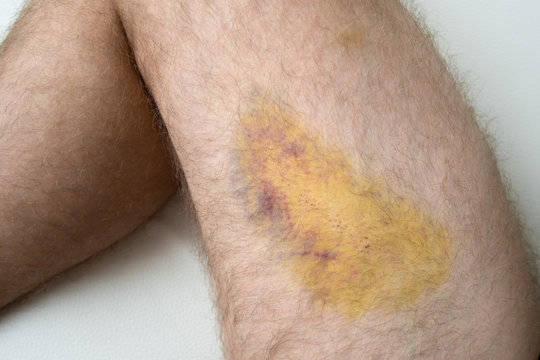 รูปภาพPrellung – เลือกดูภาพถ่ายสต็อก เวกเตอร์ และวิดีโอ278 | Adobe Stock