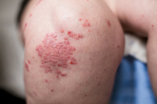 รูปภาพNeurodermatitis – เลือกดูภาพถ่ายสต็อก เวกเตอร์ และวิดีโอ496 ...