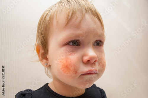 "Cute child 1 - 2 years old with eczema or allergic rash on his face ...