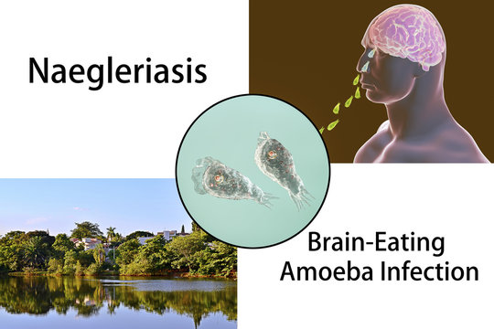 Naegleriasis bilder – Bläddra bland 73 stockfoton, vektorer och videor ...
