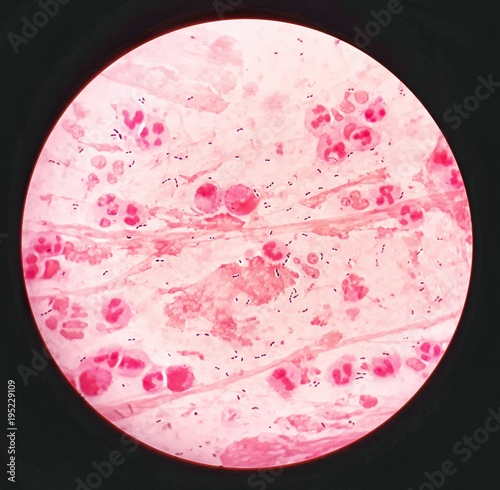 "Smear of Gram's stained from sputum specimen with gram positive cocci ...