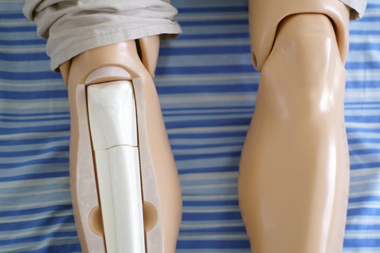 Intraosseous Imagens Procure 18 Fotos Vetores E Vídeos Adobe Stock