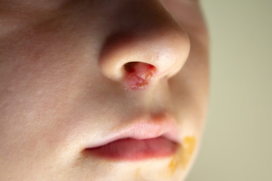Herpes Inside Nose