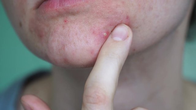 Pimple Images – Browse 182,161 Stock Photos, Vectors, and Video | Adobe ...