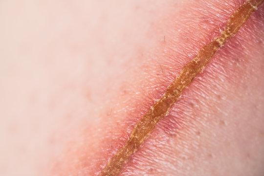 รูปภาพLaceration – เลือกดูภาพถ่ายสต็อก เวกเตอร์ และวิดีโอ205,509 ...