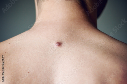 "Fibroma on the male back, details, close-up" Stock photo and royalty ...
