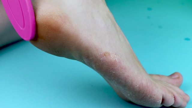 Candida Images – Browse 7,204 Stock Photos, Vectors, and Video | Adobe ...