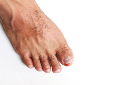 48 BEST Panaritium IMAGES, STOCK PHOTOS & VECTORS | Adobe Stock