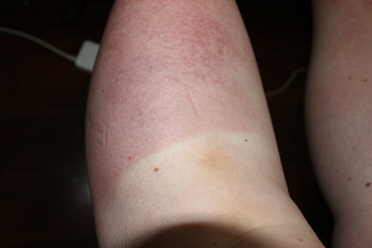 Photodermatitis Images – Browse 337 Stock Photos, Vectors, and Video ...