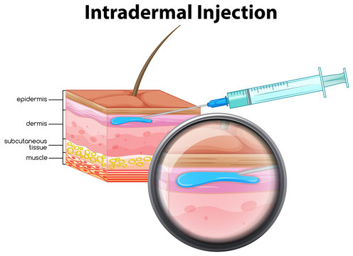 Intradermal 이미지 – 찾아보기 1,772 스톡 사진, 벡터 및 비디오 | Adobe Stock