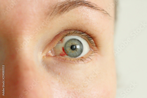 "Bloodshot eye. Woman with burst blood vessel in eye. Very red bloody ...