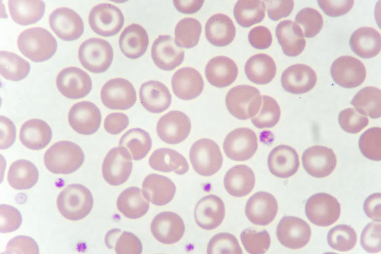 「Spherocyte」の画像 - 166 件の Stock 写真、ベクターおよびビデオ | Adobe Stock