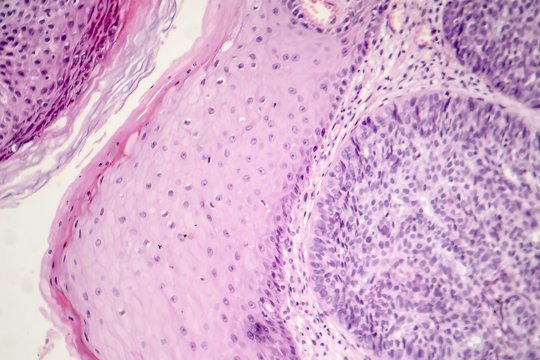 Basaliom bilder – Bläddra bland 287 stockfoton, vektorer och videor ...